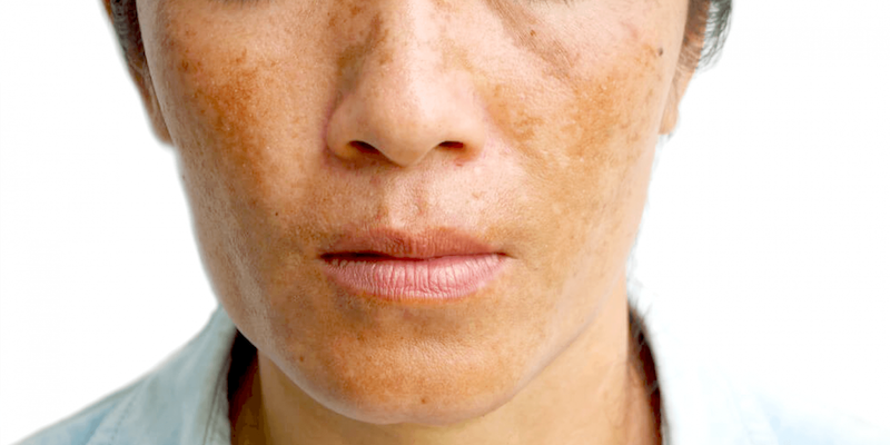 Hormonal Pigmentation | Melasma | Skin Renewal Clinics | 11 | 11